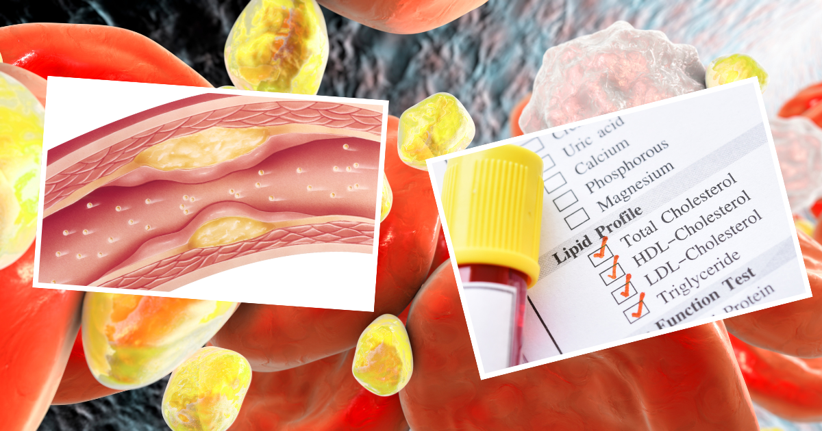 The advanced lipid metrics your doctor doesn’t know about - I Fix Hearts